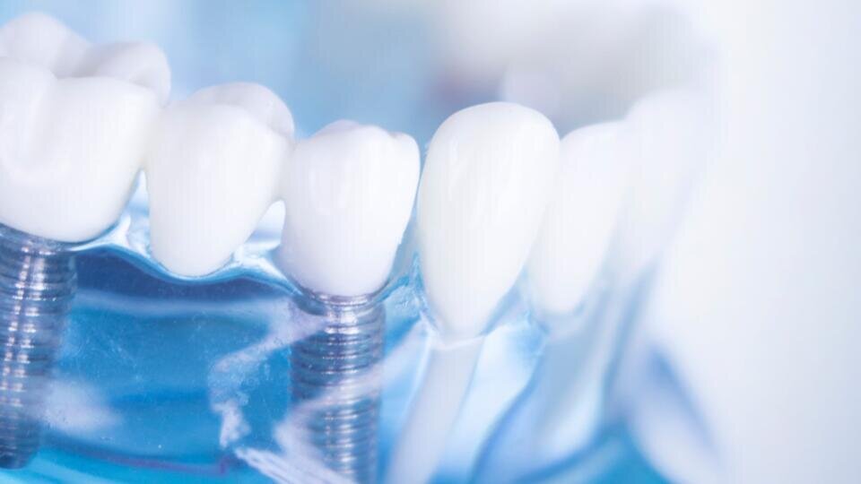 Implants, prostheses, orthoses